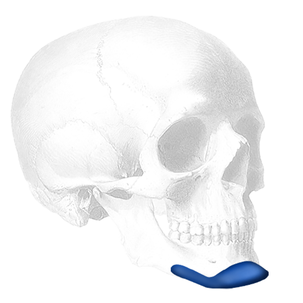 Implantech Terino Square Chin Implant - Style II – Precise Medical Supplies