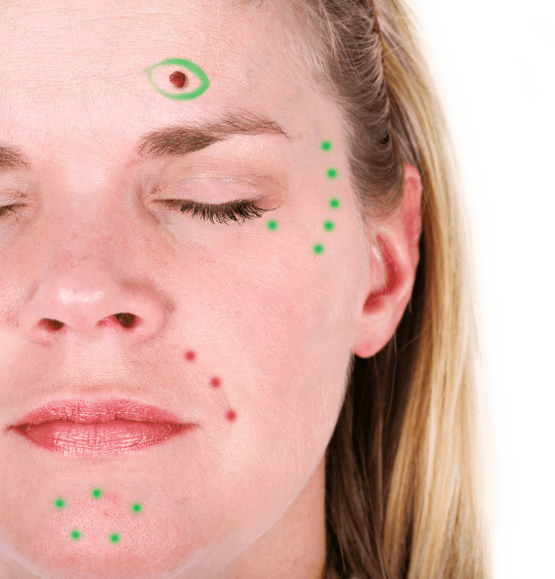 Viscot Ez Skin Marker Pens Precise Medical Supplies